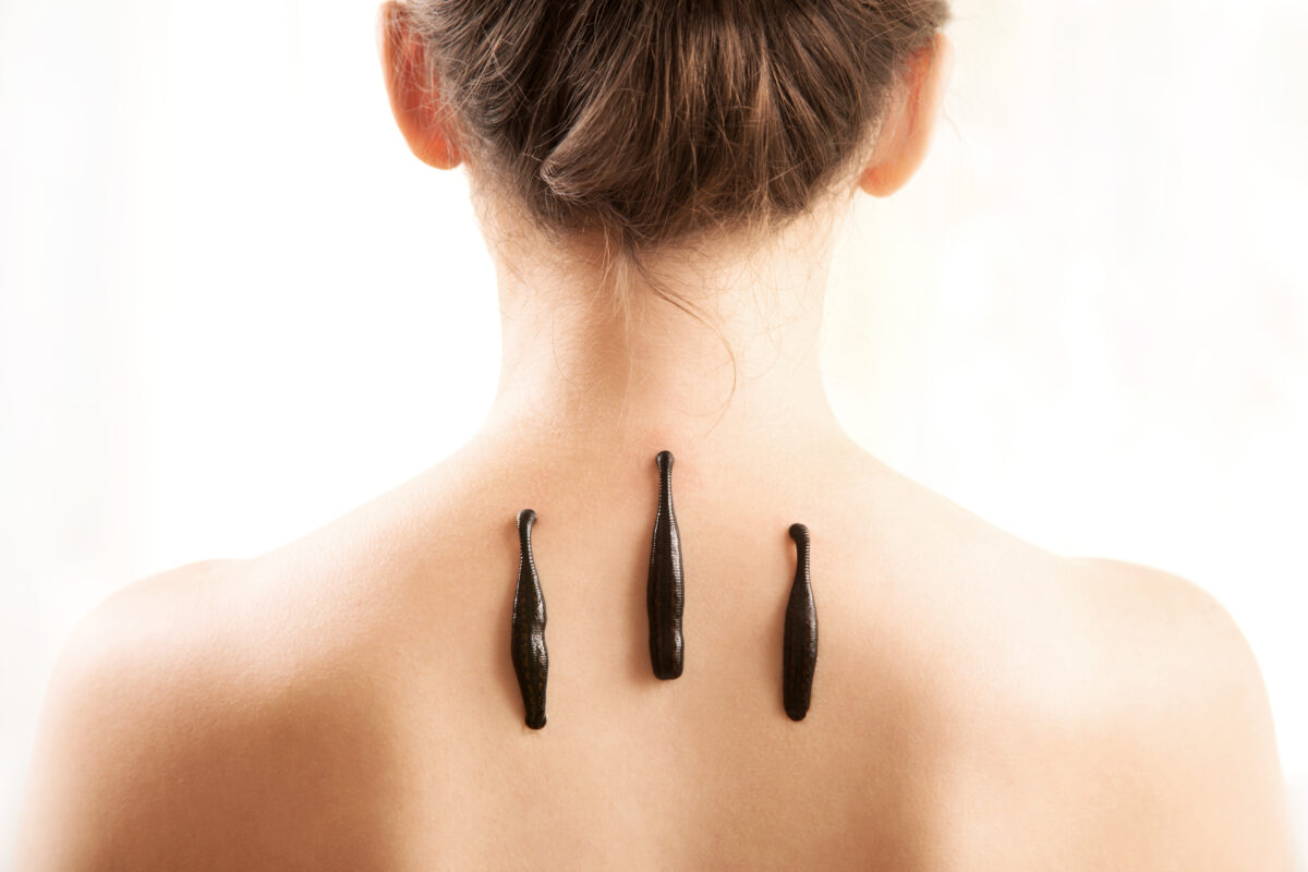 Hirudokosmetologia – pijawka lekarska, czyli „wampirzy lifting” - Anna ...